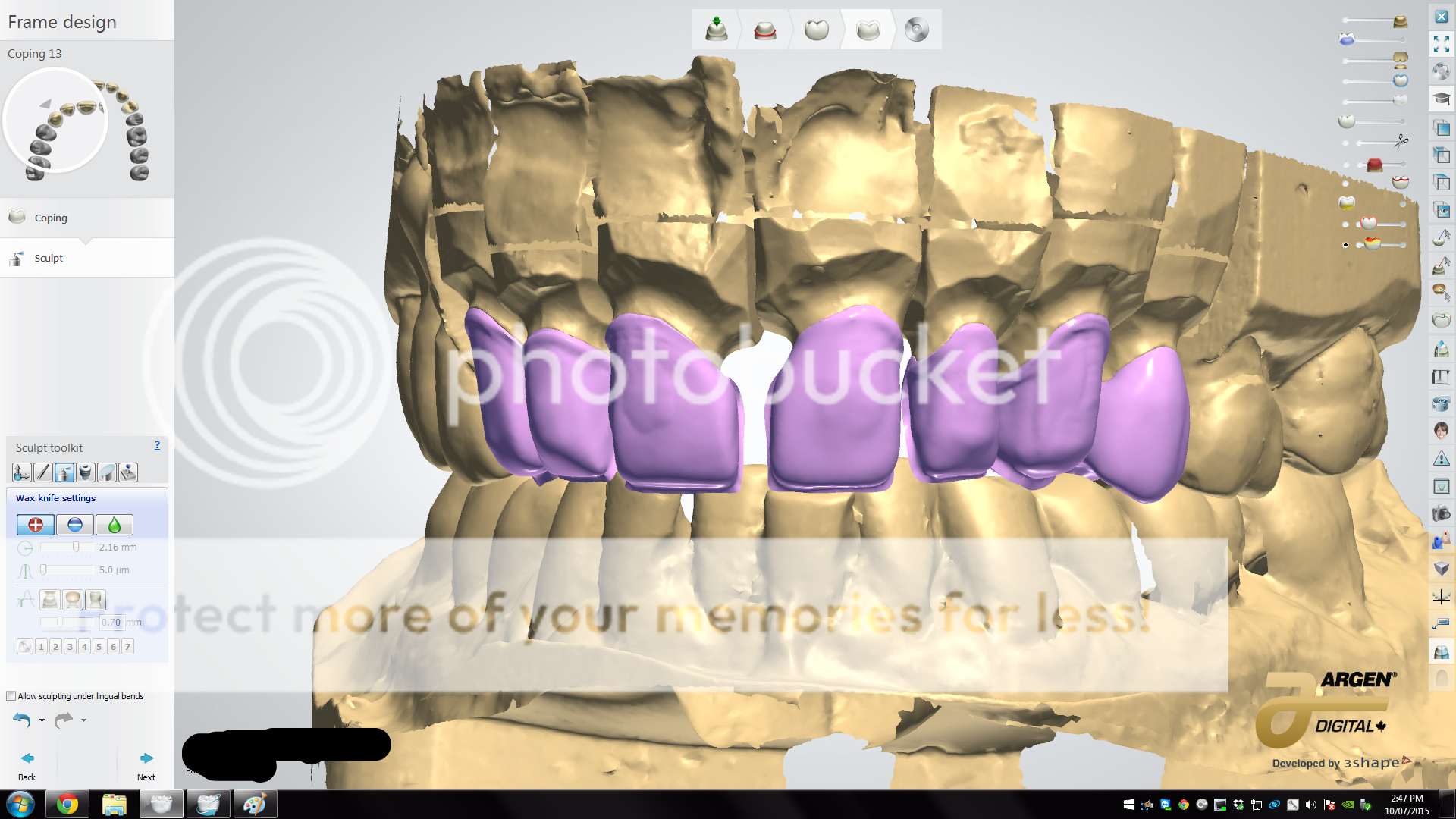 Zirconia Framework Design | Dental Lab Network